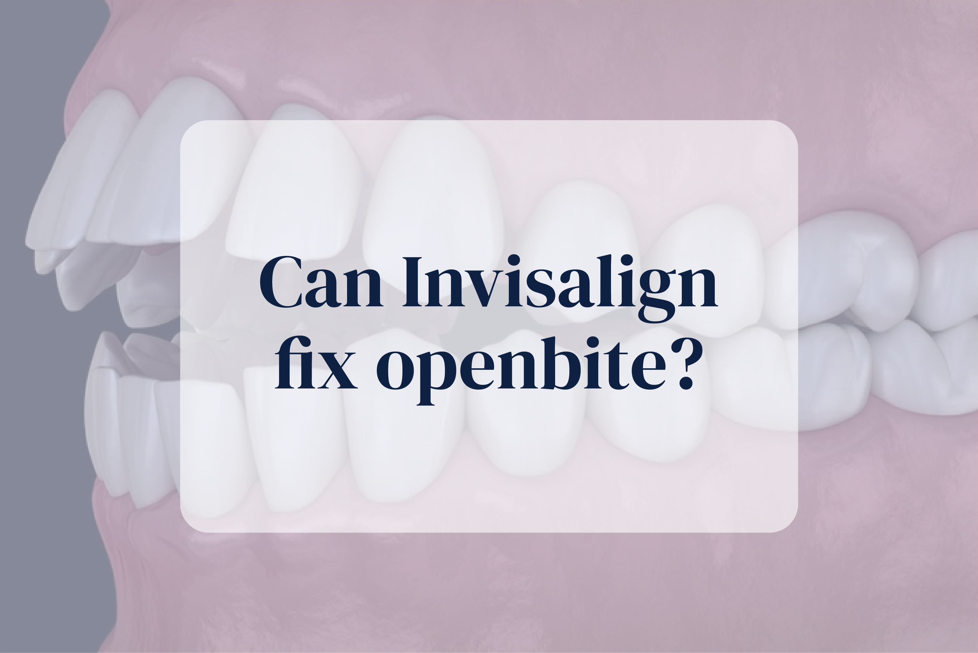 Trident Smiles Dental | Can Invisalign Fix Open Bite? Trident Smiles Dental | Can Invisalign Fix Open Bite?
